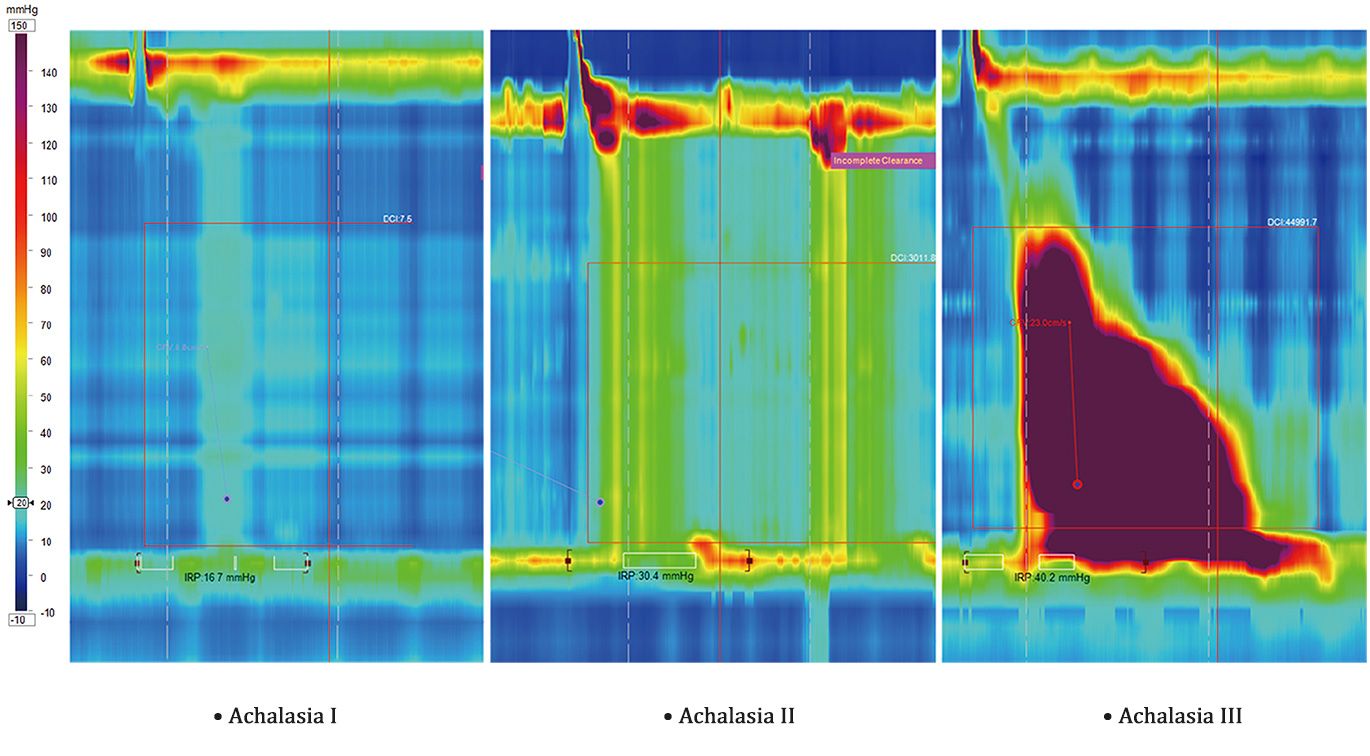 High Resolution Manometry System_JINSHAN